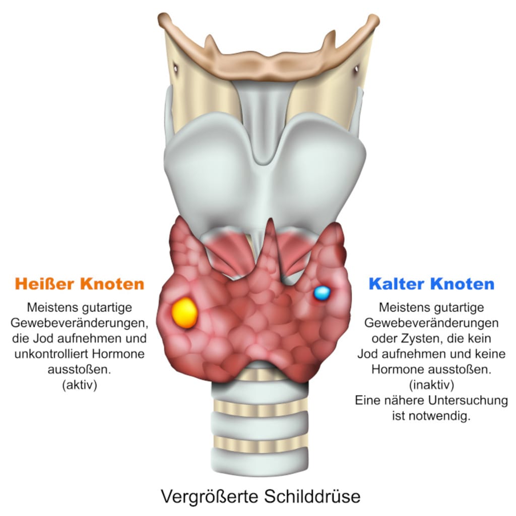 Vergrößerte Schilddrüse: Ursachen, Symptome und Behandlung einer Struma